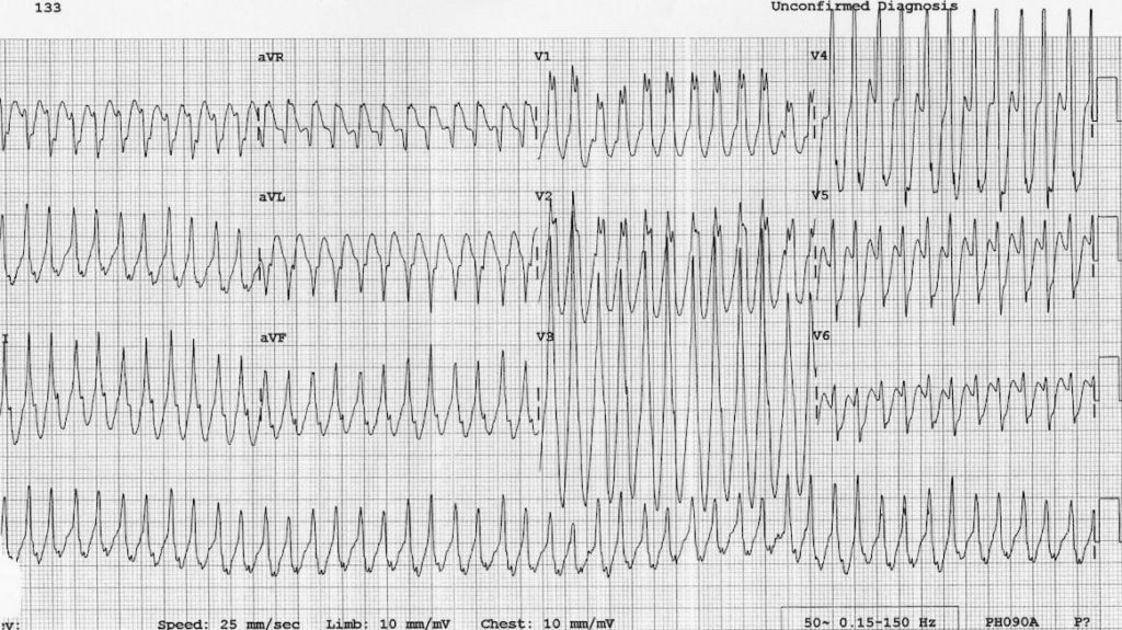 Pre-excitation syndromes – MyNotes