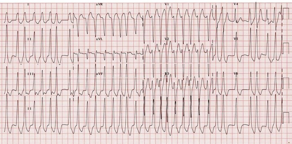 Pre-excitation syndromes – MyNotes