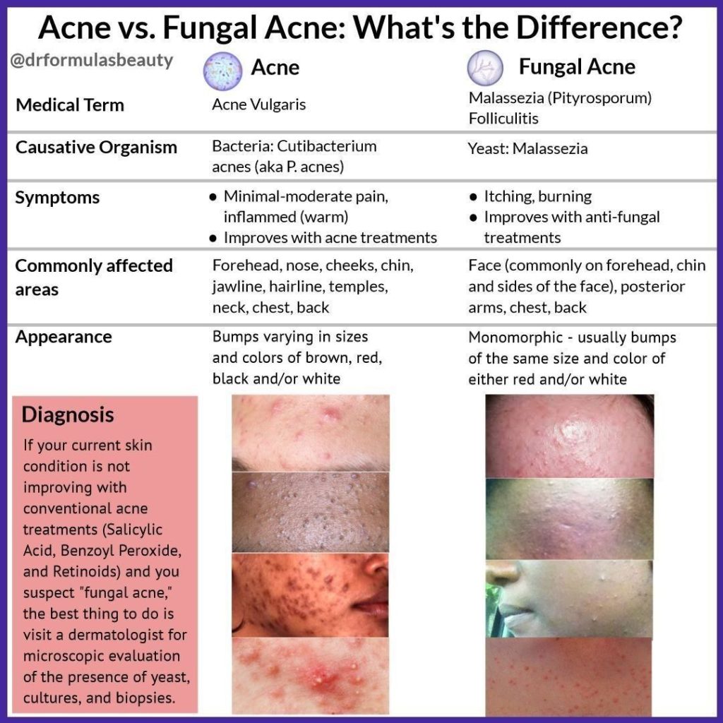 Folliculitis – My GP Notes