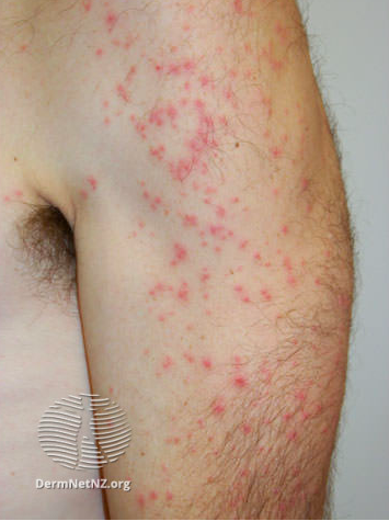 Cercarial dermatitis(swimmer’s itch) – My notes