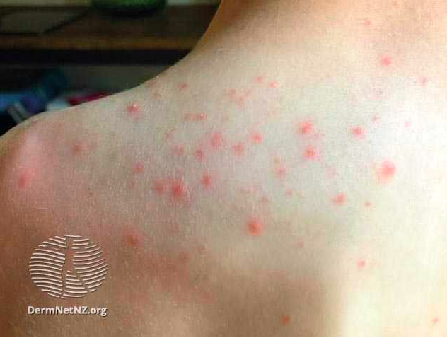 Cercarial dermatitis(swimmer’s itch) – My notes