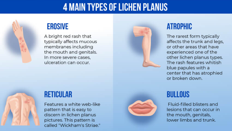 Lichen planus – My notes