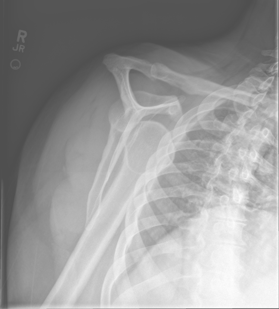 Shoulder Dislocation – My notes