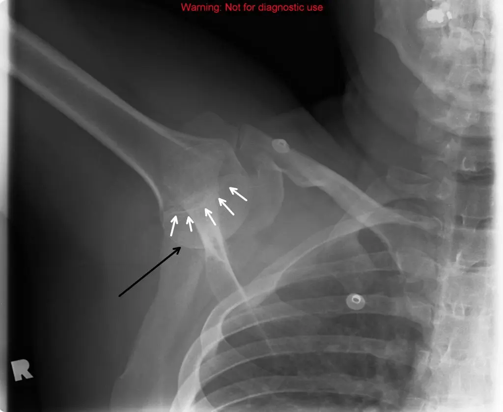 Shoulder Dislocation – My notes