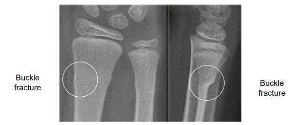 Distal Radius Fractures – My GP Notes