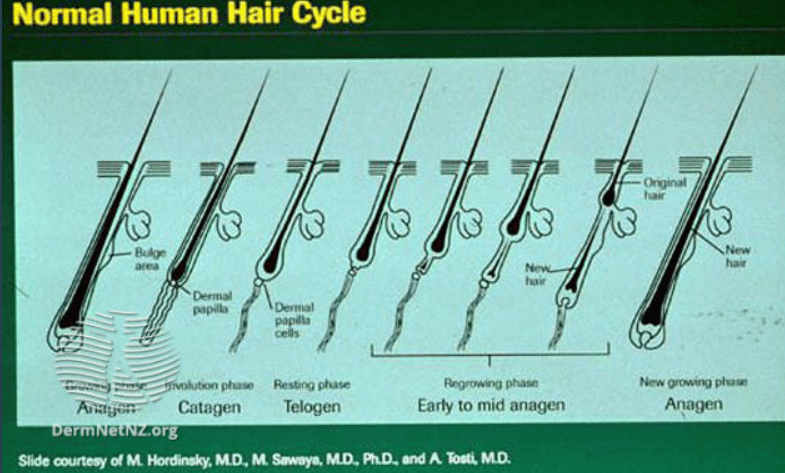 Androgenetic alopecia – MyNotes