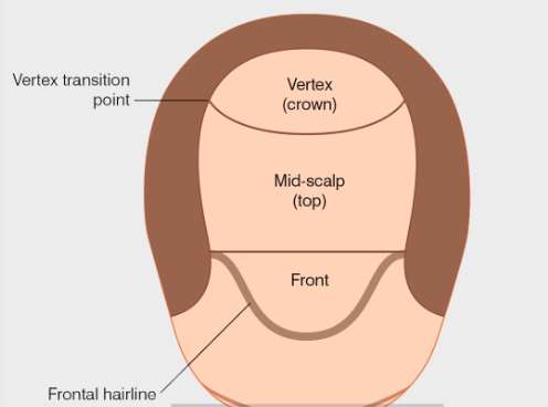 Androgenetic alopecia – MyNotes