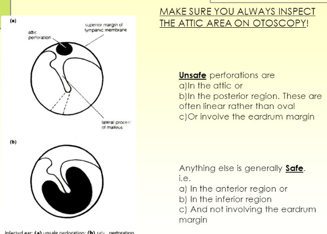 Acute Otitis Media with Perforation (AOMwiP) – MyNotes