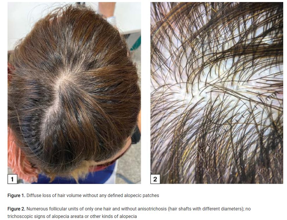 Alopecia – MyNotes