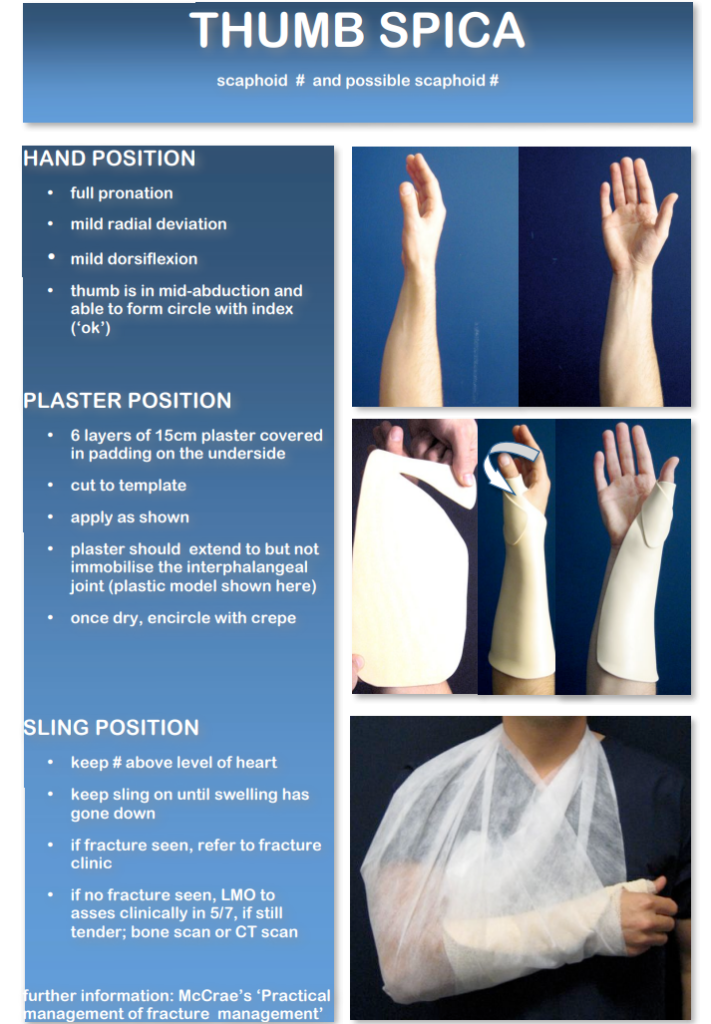 Scaphoid Fracture – My notes