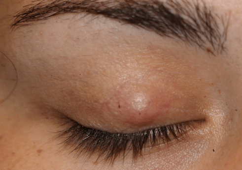 Chalazion and Hordeolum (stye) – My notes