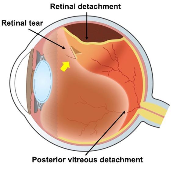 Posterior vitreous detachment – My notes