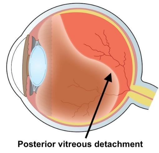 Posterior vitreous detachment – My notes