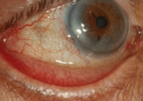 Eye lid issues – My notes