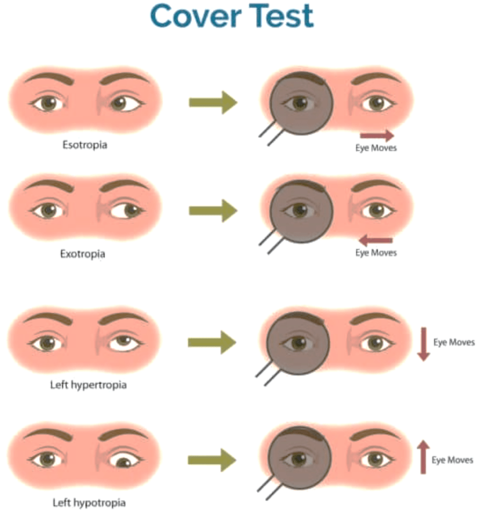 Strabismus (squint) – My notes