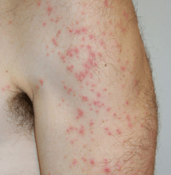 Schistosomiasis – My GP Notes